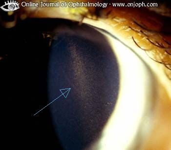 Medicine Decoded: Corneal Pigmentation – Decoded